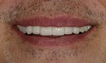 Smile Gallery Peachtree Corners, GA | Peachtree Corners Dentistry