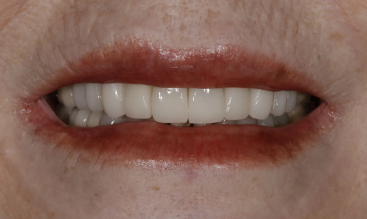 Smile Gallery Peachtree Corners, GA | Peachtree Corners Dentistry