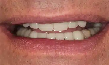 Smile Gallery Peachtree Corners, GA | Peachtree Corners Dentistry