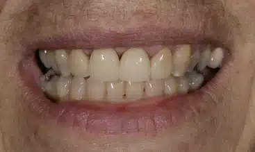 Smile Gallery Peachtree Corners, GA | Peachtree Corners Dentistry